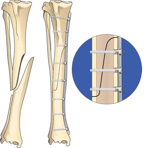 Fracture Management-backup – All-in-One Ortho-online