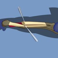 Open Transverse Reduction Technique – All-in-One Ortho-online