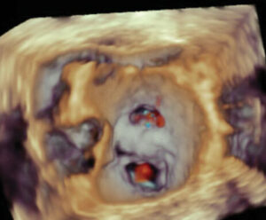 Transcatheter Edge-to-Edge Mitral Valve Repair (TEER) - Veterinary ...